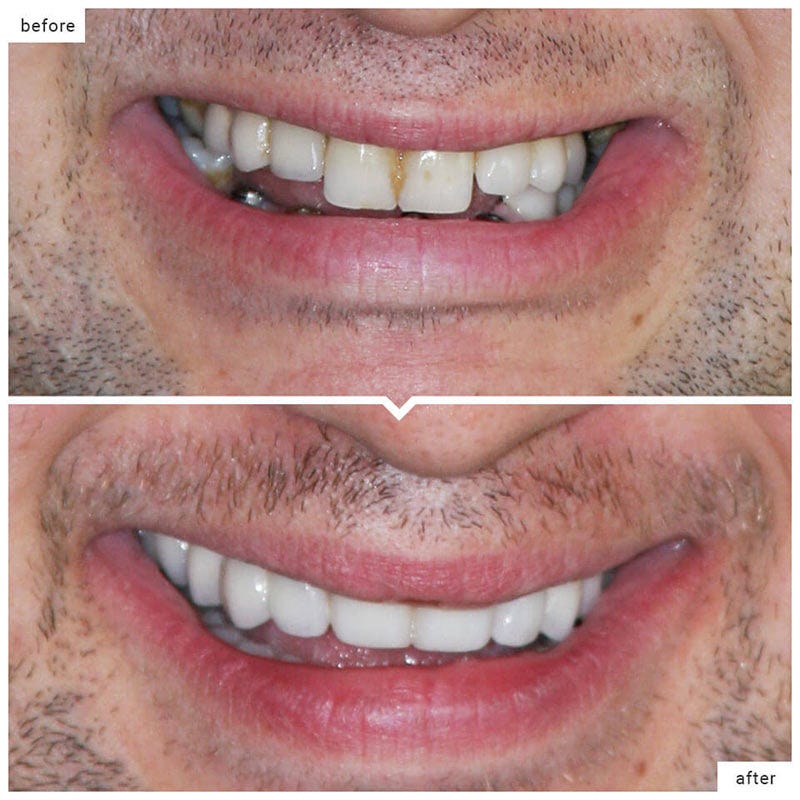 Dental Implants. You don’t have to walk around with… | by Soho Smile ...