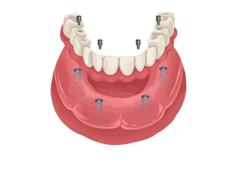 Signs of Poor Dental Bridge Fit | by Symptom Finder | Medium