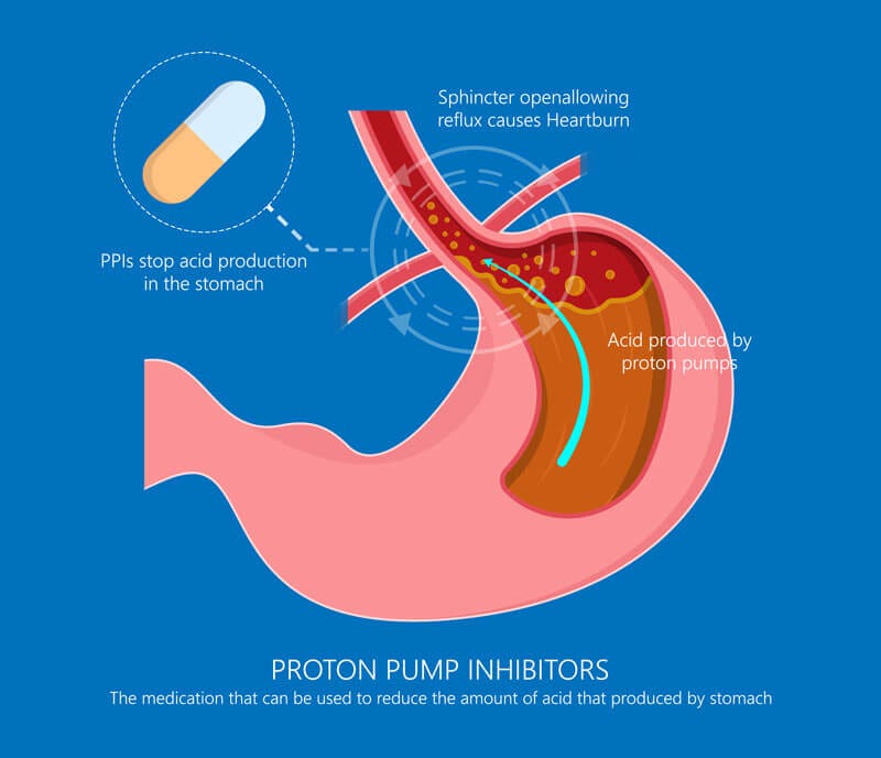 Long term acid suppressant medications — Proton pump inhibitors (PPI’s ...