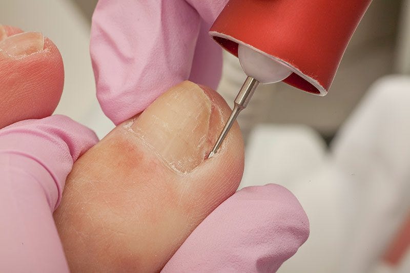 Know Everything about Paresthesia and How to Treat It | by Bay Podiatry ...