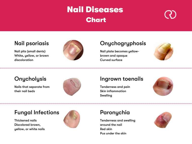 Types of Nail Diseases With Pictures: Spot & Treat Early! | by ...