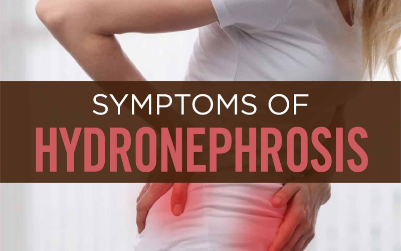 What are the symptoms of hydronephrosis? - Sankalphospitalvadodara - Medium