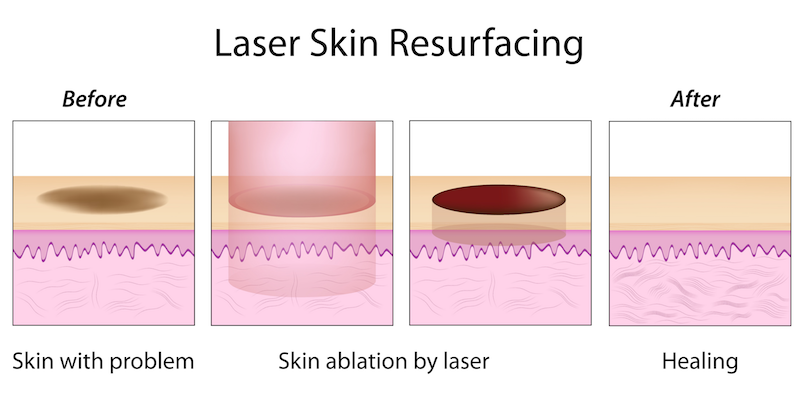 How to Prepare for Laser Skin Resurfacing | by Michele Zormeier MD | Medium