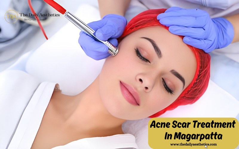 Unlocking Radiant Skin: The Best Acne Scar Treatment in Magarpatta | by ...