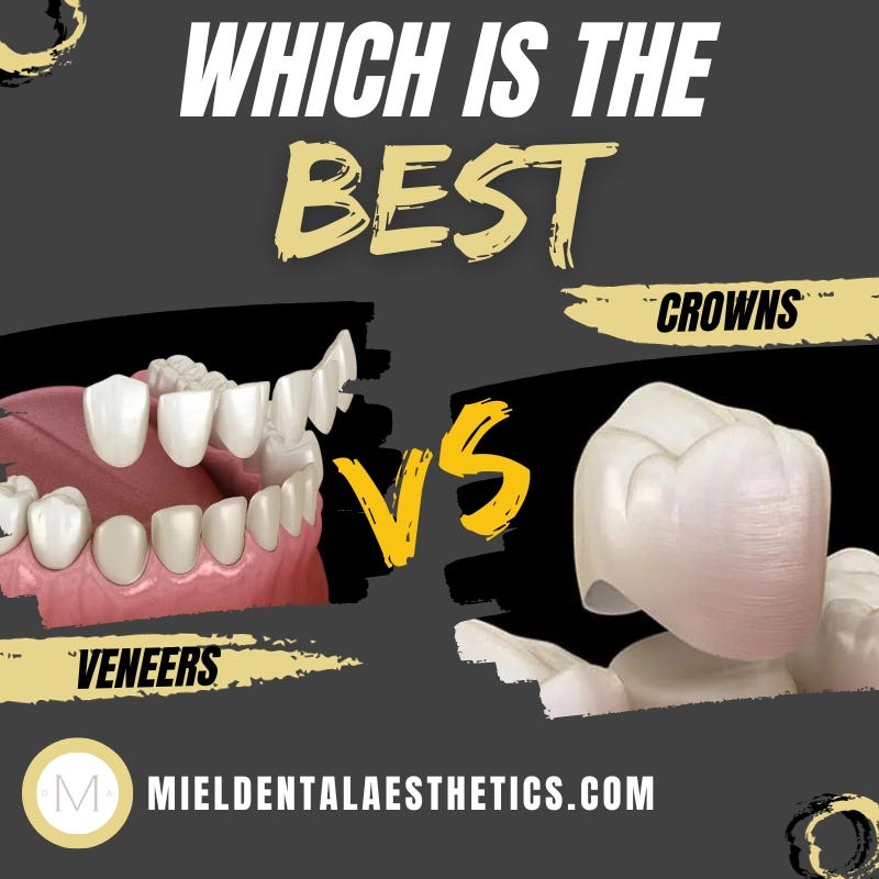 The Battle of Smiles: Veneers vs. Dental Crowns in Peabody | by Miel Dental Peabody Aesthetics ...