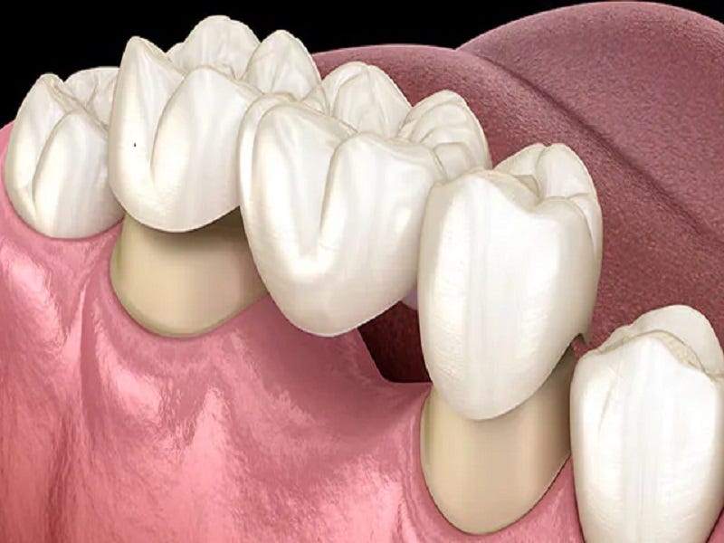 What Are Dental Crowns | Lawrenceville Ga dental crowns - Carla Grayson ...