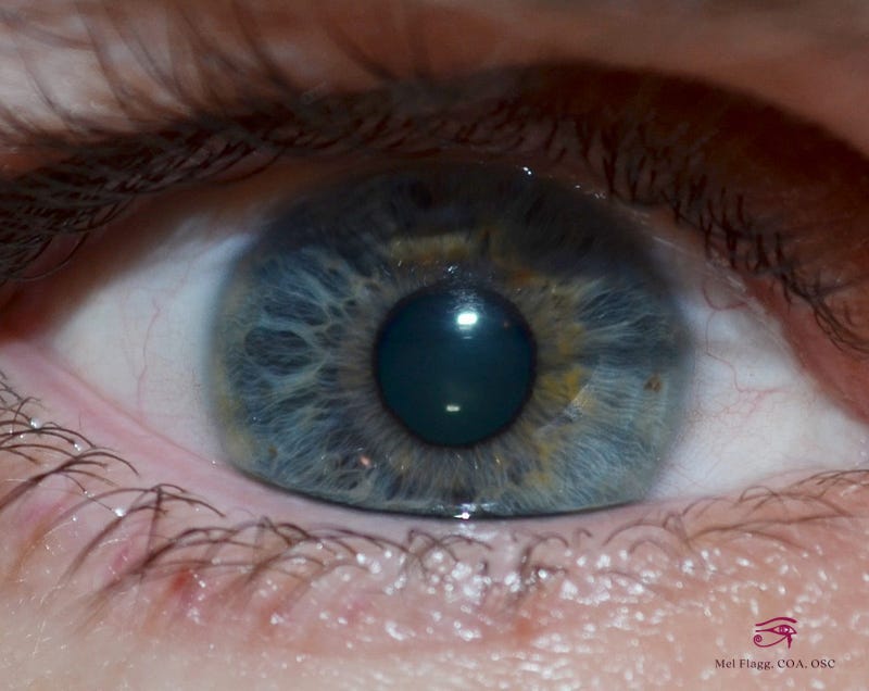 When Tears Run Dry: Exploring the Symptoms, Causes, and Treatments of ...
