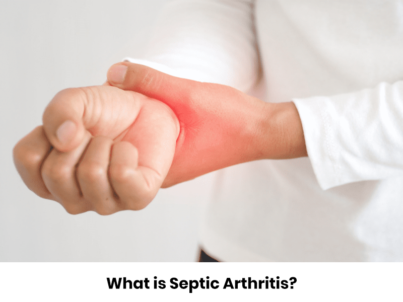 What is Septic Arthritis?. Septic arthritis, also termed as… | by ...