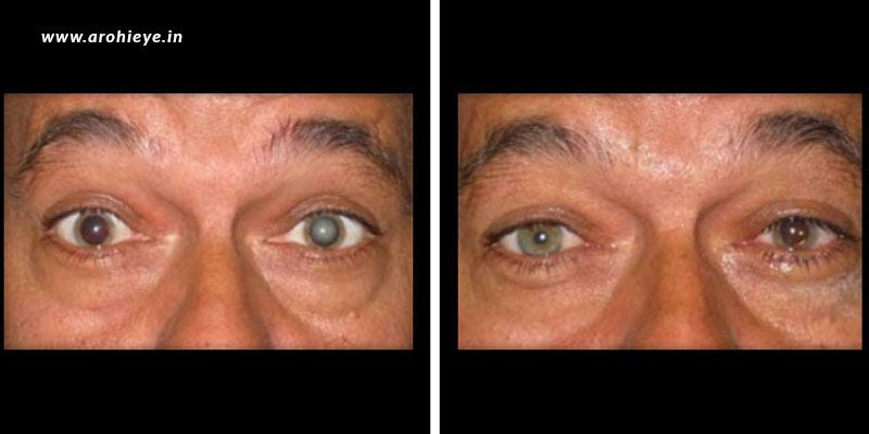 Cataract Surgery — Before And After — Arohi Eye Hospital | by shradha ...
