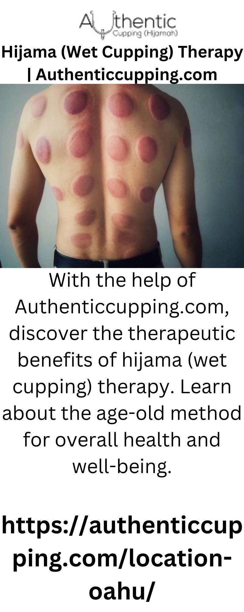 Hijama (Wet Cupping) Therapy | Authenticcupping.com - Authentic Cupping - Medium
