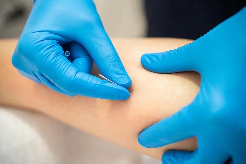 Dry Needling: A Pricking Sensation with Promising Results in Australia ...