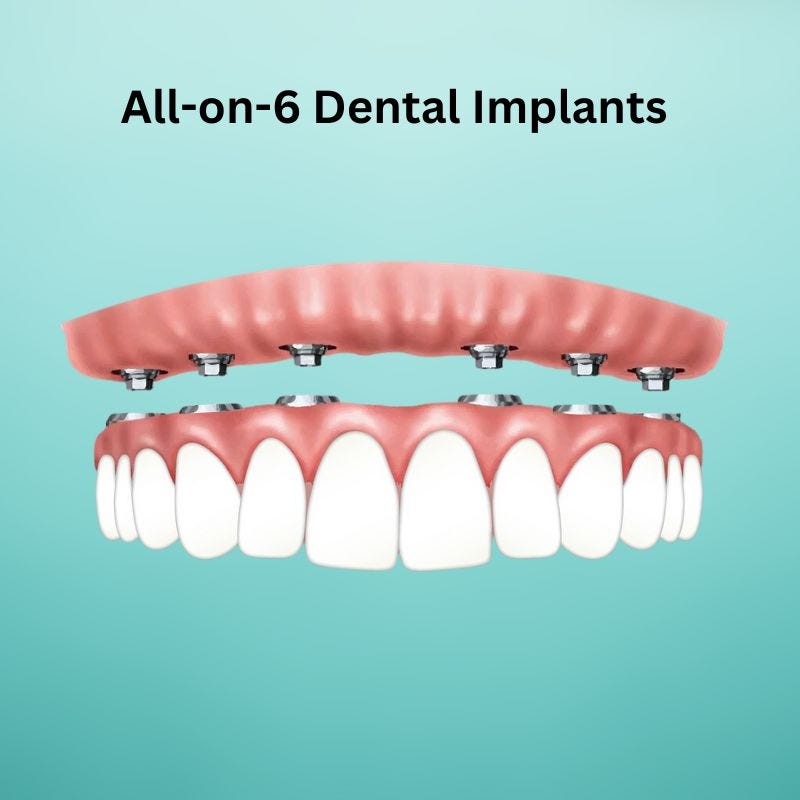 The Process of All on 6 Dental Implants: A Comprehensive Guide | by Dr. Ahdout Cosmetic ...