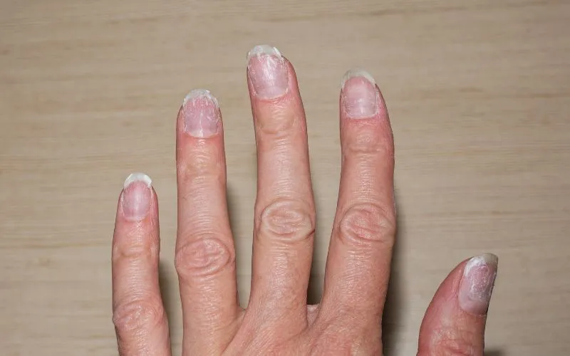 What does it mean when your fingernails are peeling ...