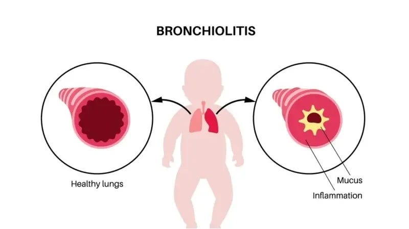 Bronchiolitis and RSV in Infants and Children: Essential Information Every Parent Should Know ...