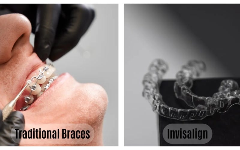 The Pros and Cons of Invisalign vs. Traditional Braces | by Darley ...