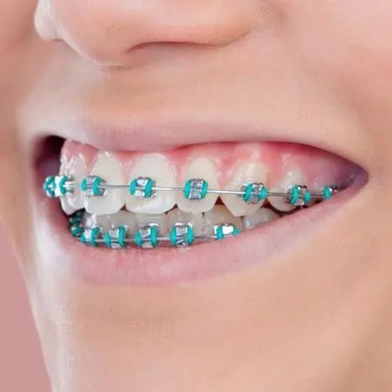 How long braces take?. Braces are a popular orthodontic… | by ...