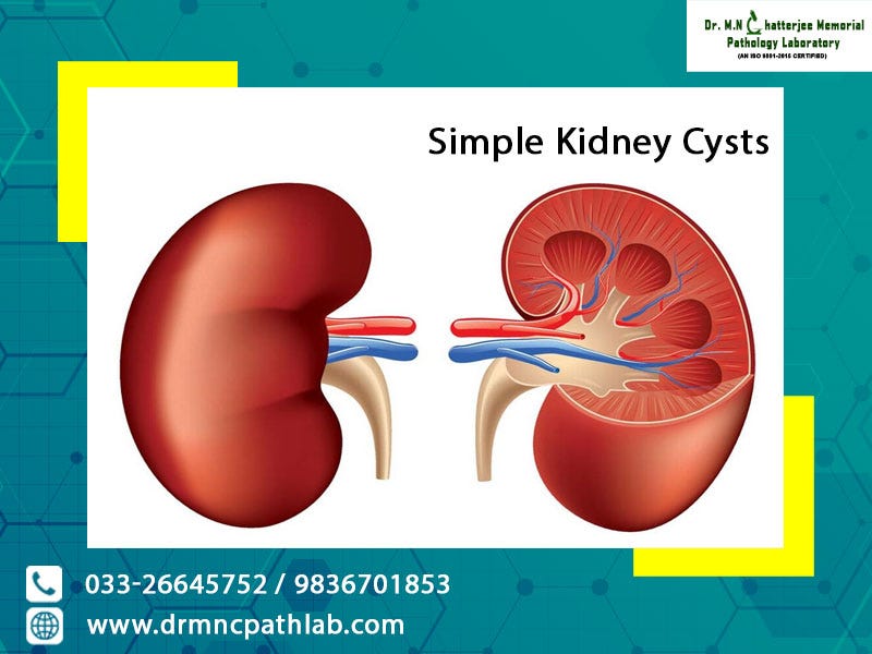 Simple Kidney Cysts. Fluid-filled sacs within the kidneys… | by Rahid ...