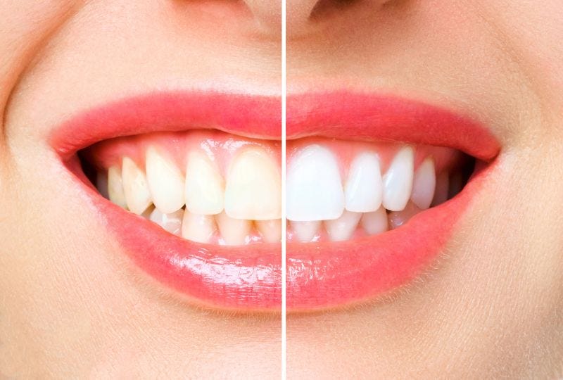 Teeth Whitening The Ultimate Guide To Achieving A Brighter Smile By
