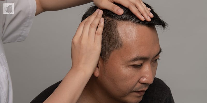 Hair Care Steps To Follow After Undergoing Hair Restoration Treatment ...