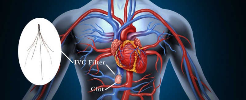 What are the complications of IVC filter? | by IVC Filter Settlements ...