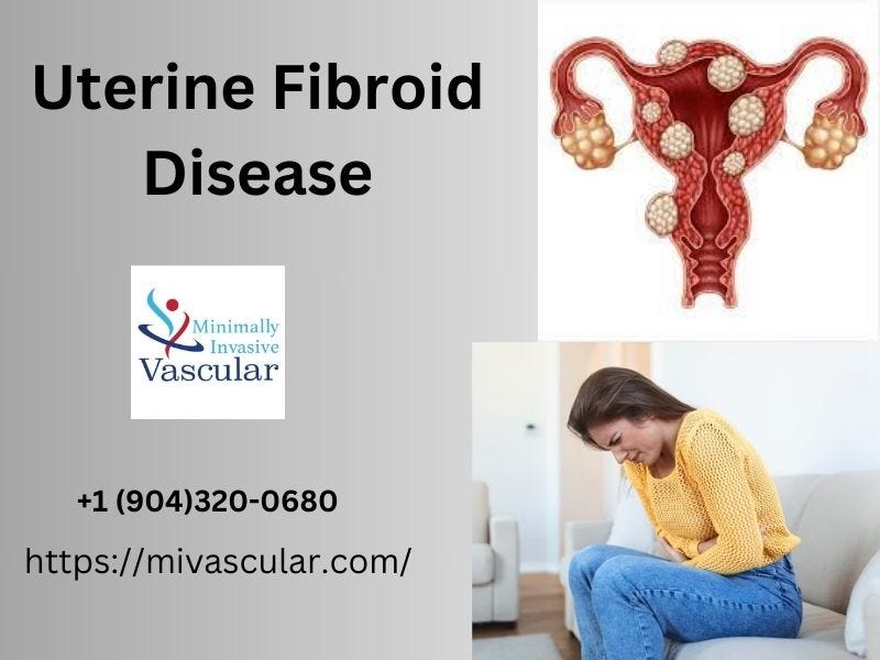 Uterine Fibroid Disease - Minimally Invasive Vascular - Medium