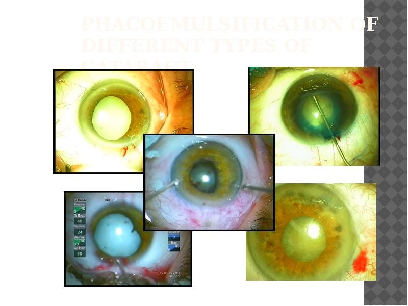 Phacoemulsification Systems: Precision in Ophthalmic Surgery | by giya ...