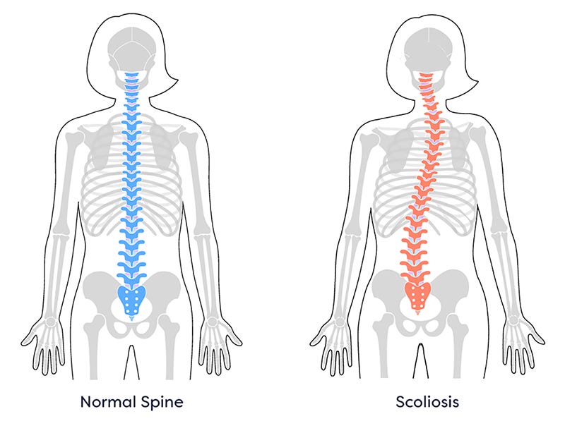 Scoliosis spine surgery. Curvature of the spine, called… | by Premier ...