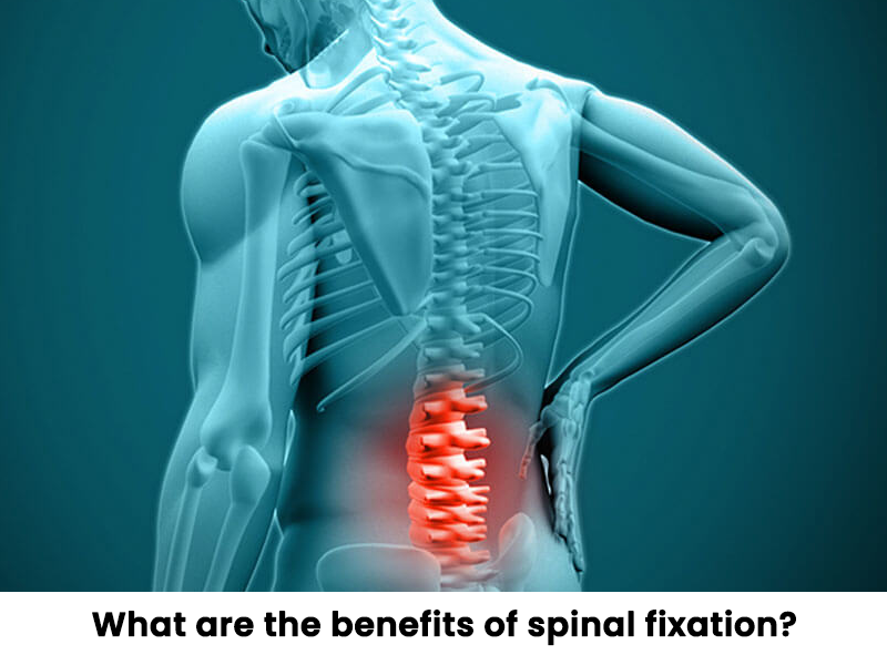 What are the Benefits of Spinal Fixation? | by Apurba Digitalgoogly ...