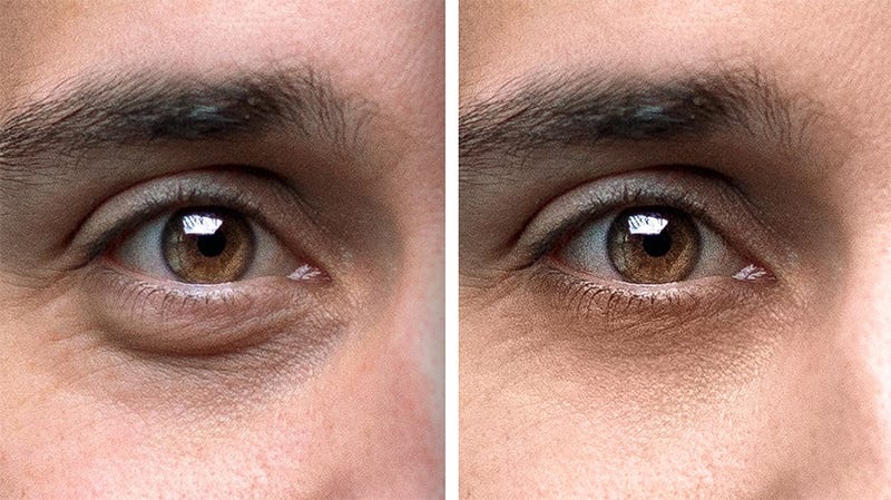 What are the eyebags above cheek bones called? Can they be reversed ...