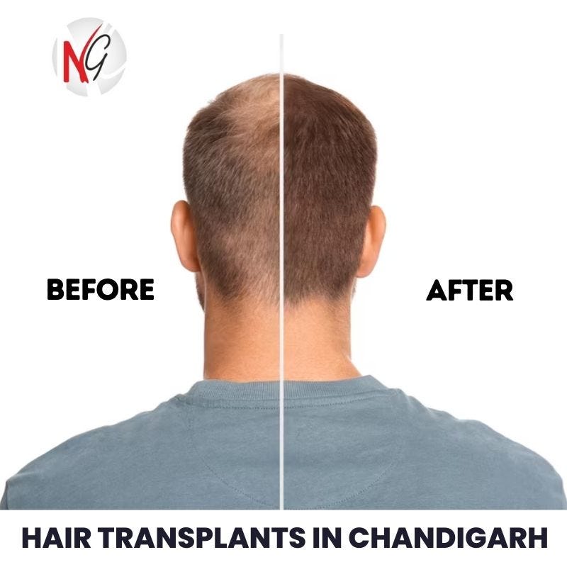 NeoGraft: Trusted Hair Transplant Experts - NeoGraft Hair Clinic - Medium