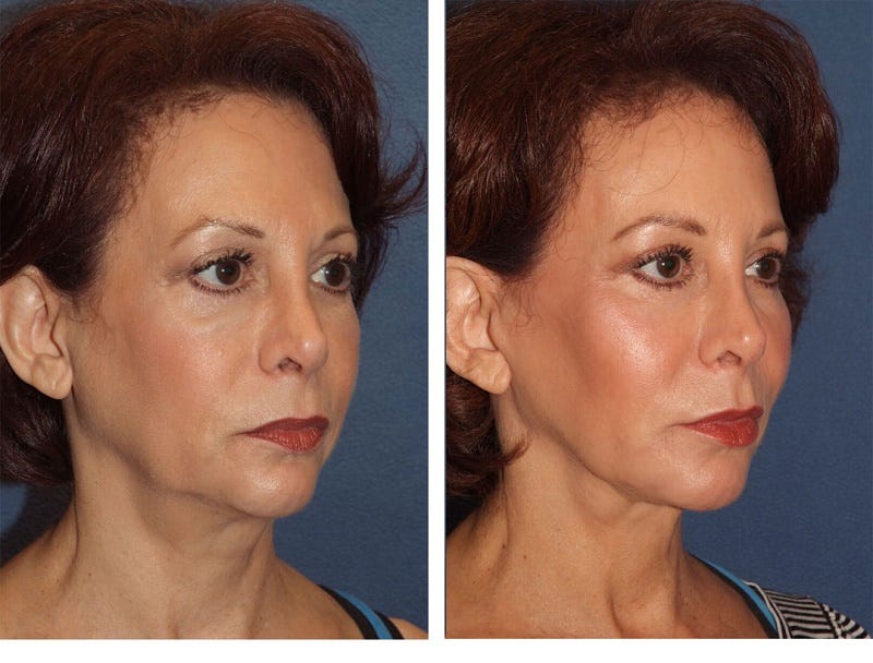 Fat Injectable — Louisville Plastic Surgeon | by Louisville ...