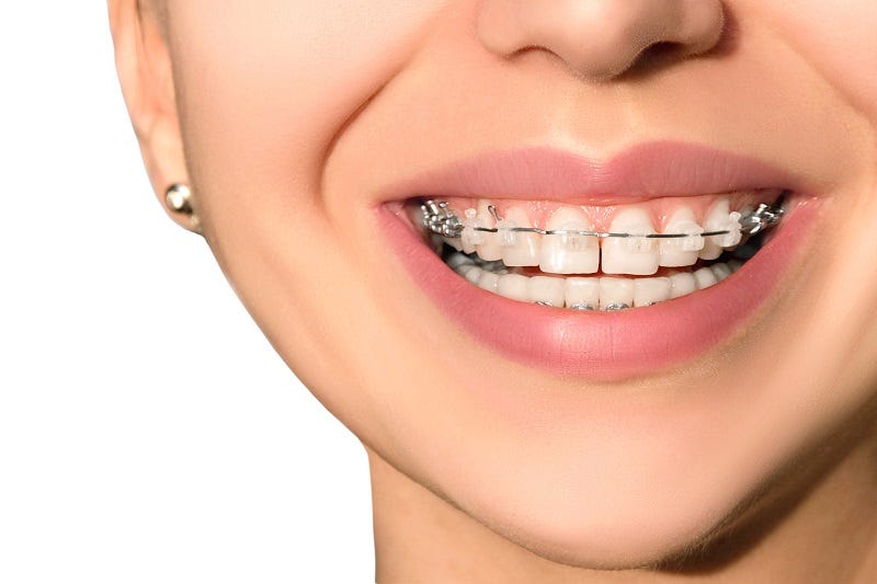 How Orthodontics Enhances Your Facial Features | by Naba Dental | Medium