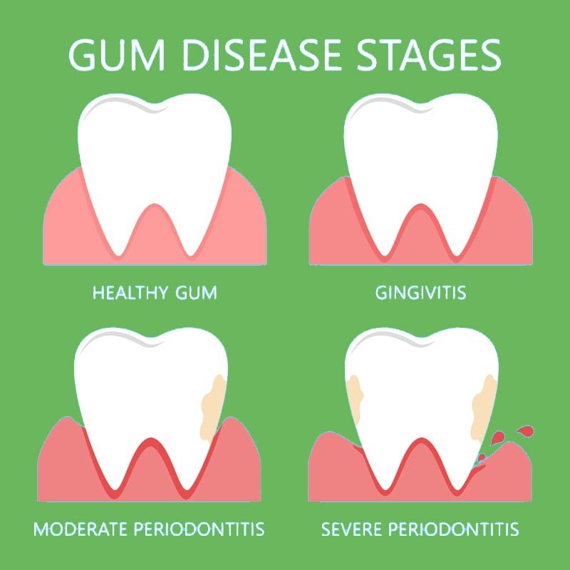 Periodontal Disease: Understanding Symptoms, Causes, and Treatment ...