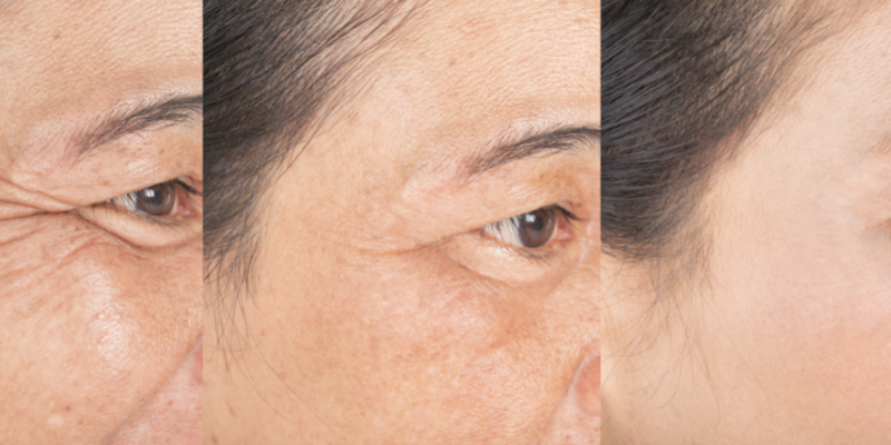 Lasers to Reduce Loose Skin and WrinklesLasers to Reduce Loose Skin and ...