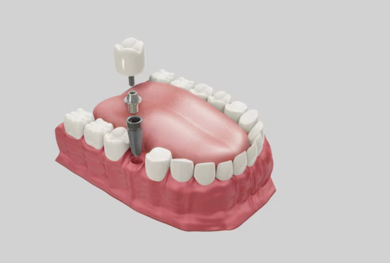 The Ultimate Guide to Dental Crowns: Everything You Need to Know | by ...