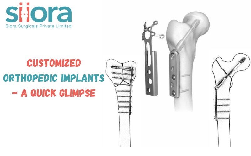 Customized Orthopedic Implants — A Quick Glimpse - Siora surgical - Medium