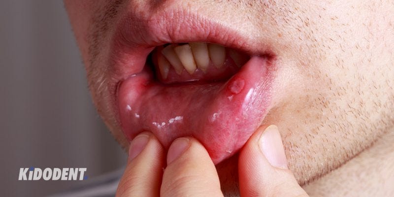 What is oral cancer (mouth cancer)? | by dentalhealthblog | Medium