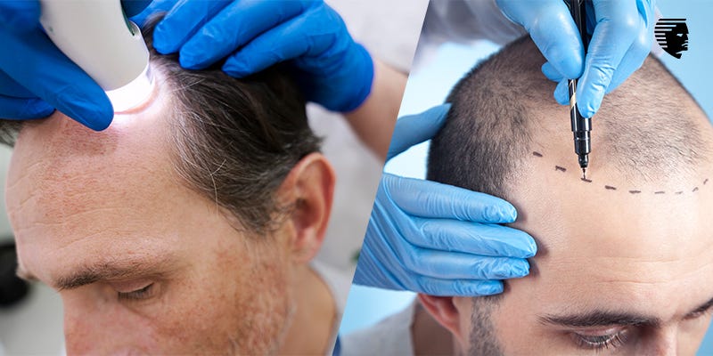 Hair Restoration in New Jersey: Benefits of Hair Restoration Techniques ...