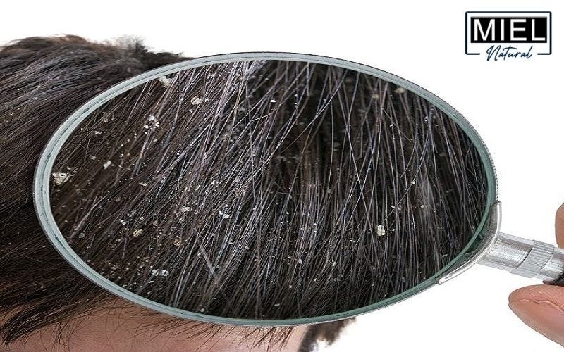 Miel Natural | Natural Remedies for Dandruff | by David Jones | Medium