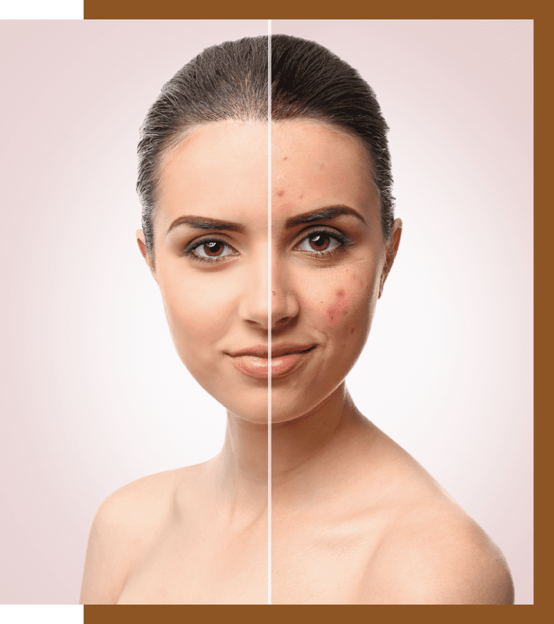 How To Get Rid Of Acne Scars Types Treatment Cost And Prevention Tips By Dermiq Clinic Medium