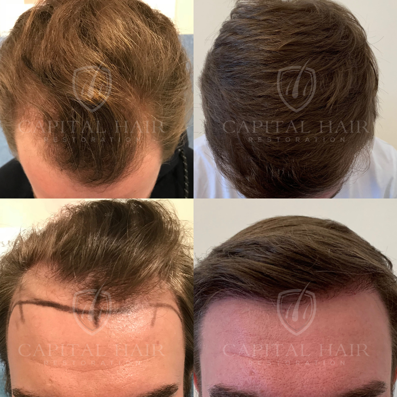 Hair Restoration: Revitalizing Your Confidence with Advanced Solutions ...