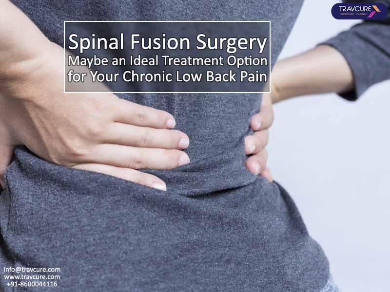 Spinal Fusion Surgery Maybe an Ideal Treatment Option for Your Chronic ...