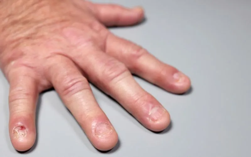 What are spoon nails and how can they affect your overall nail health ...