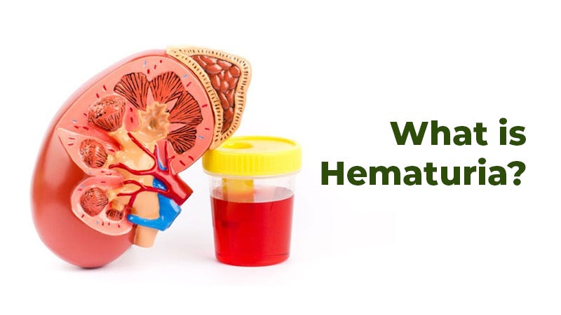 What is Hematuria?. Hematuria is a medical condition… | by Trustwell ...