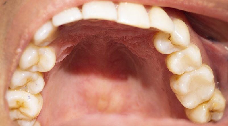 Why is Professional Teeth Cleaning Important? | by Jason Clark | Medium