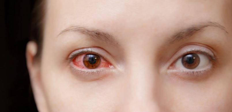 Recognizing Red Eyes Triggers: Allergies, Infections, and More | by ...