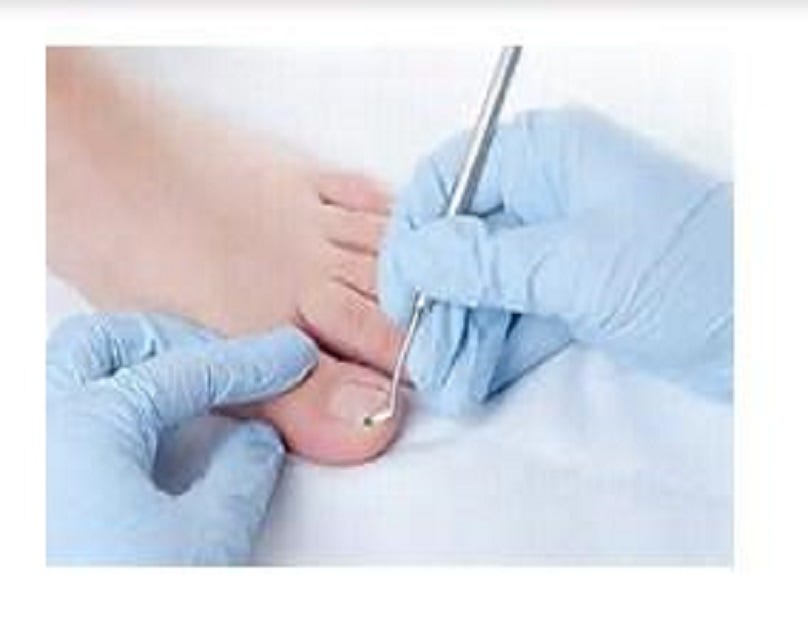 How painful is ingrown toenail surgery? | by Suncoastpodiatry | Medium