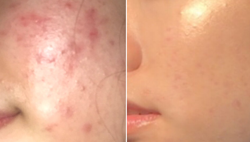 The Ultimate Skincare Routine for Acne-Prone Skin: Your Path to a Clear ...