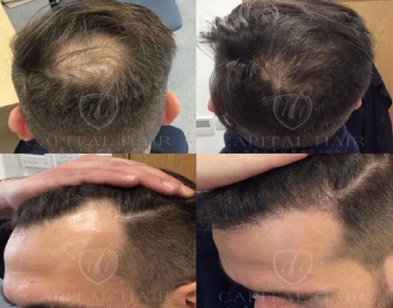 Discover the Ultimate Hair Transplant Package to Turkey: Your Path to ...