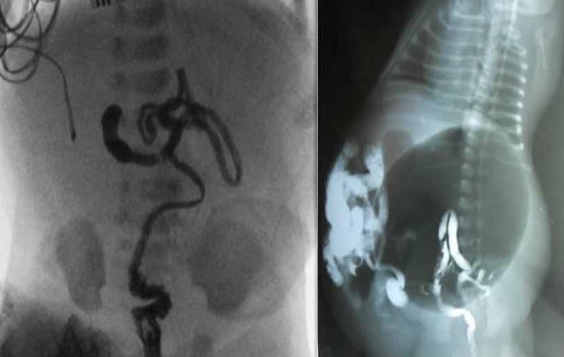 Megacystis-Microcolon-Intestinal Hypoperistalsis Sendromu | by İ ...